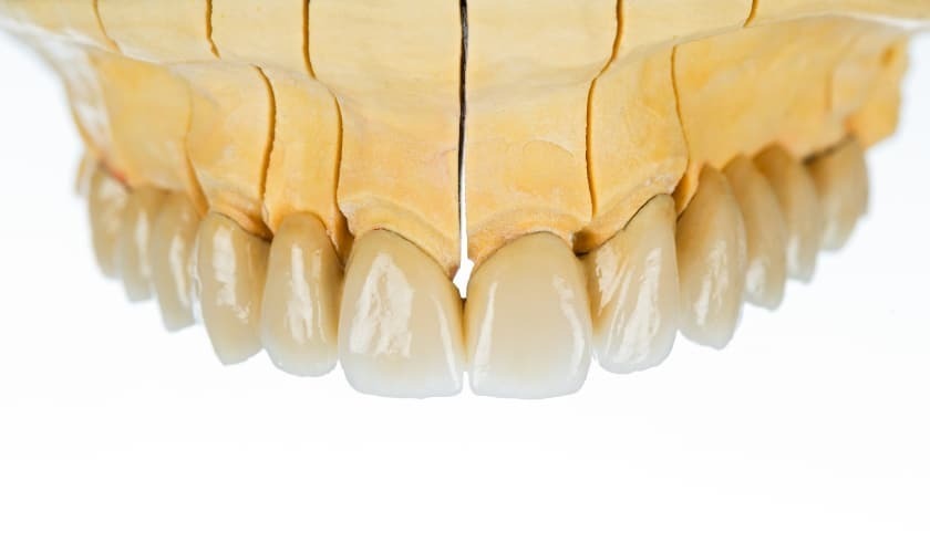 What Are the Advantages of Porcelain Bridge?